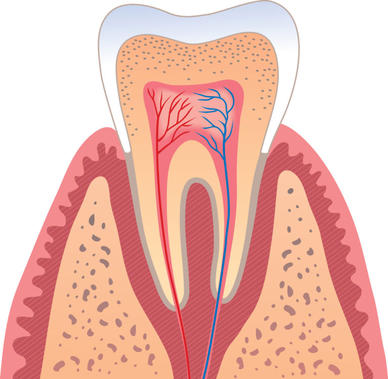 Muela picada, ¿cómo puedo saber si la tengo infectada? | Clínica dental ...